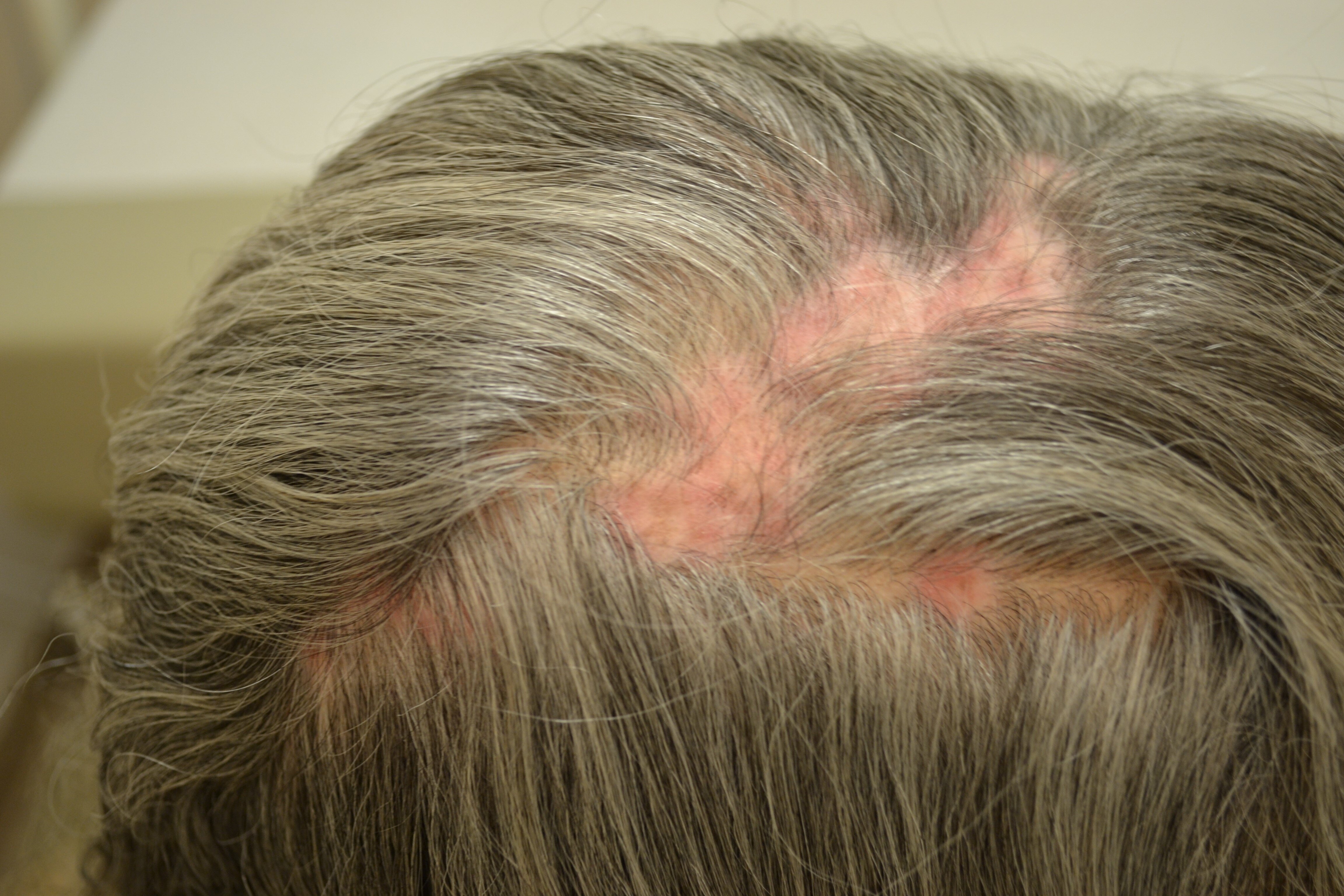 Discoid Lupus Erythematosus